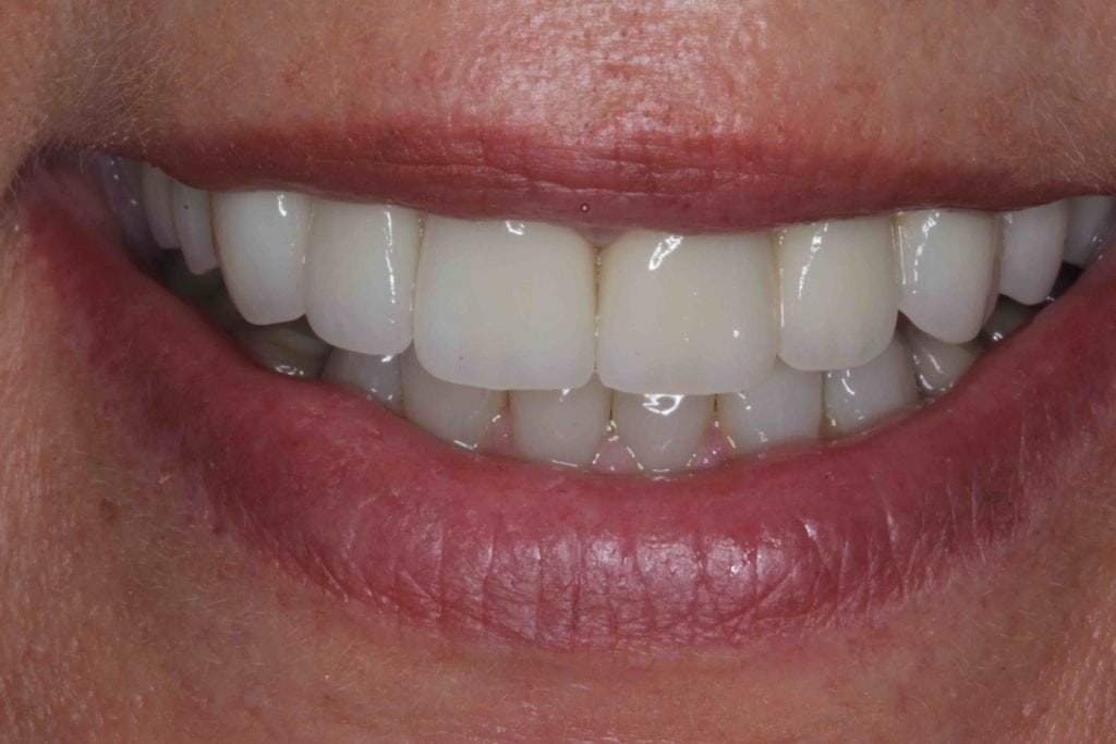 Smile Makeover Before After Gallery Cosmetic Dentists In Lancashire