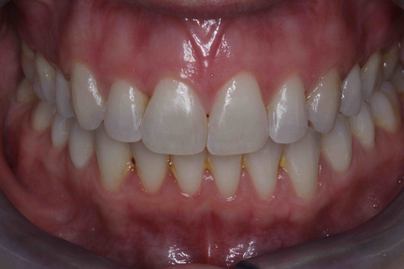 Porcelain veneers Before After - Lane Ends Dental Practice